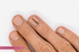 Understanding the Nail Matrix - RemoteDerm