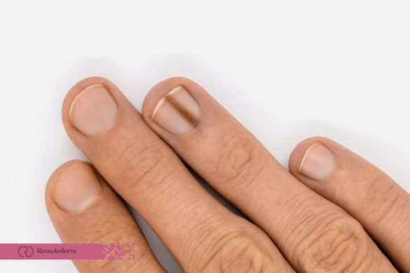 Nail Diseases Chart: Picture, Sign and Treatment