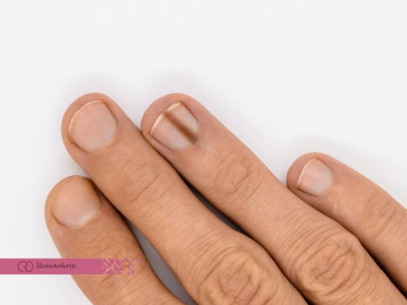 Melanonychia Nail: Causes & Treatment - RemoteDerm