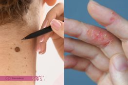 Can I take valtrex for cold sores? - RemoteDerm