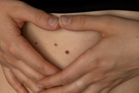 Eczema vs. Skin Cancer - RemoteDerm