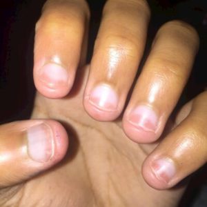 What Causes Terry's Nails? - RemoteDerm