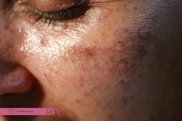 How To Get Rid of Sebum? - RemoteDerm