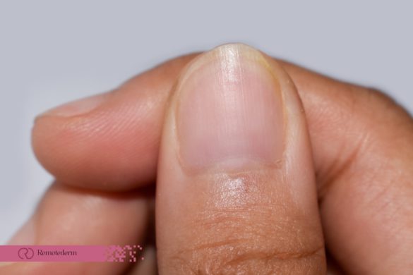 Caring for the Proximal Nail Fold - RemoteDerm