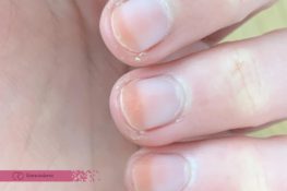 Understanding the Nail Matrix - RemoteDerm