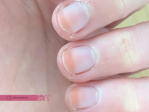 What Causes Terry's Nails? - RemoteDerm