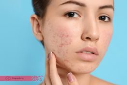 Facial Plethora: Causes and Treatments - RemoteDerm