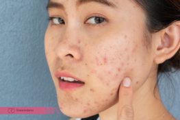 Acne vs. Pimples: What's the Real Difference? - RemoteDerm Blog