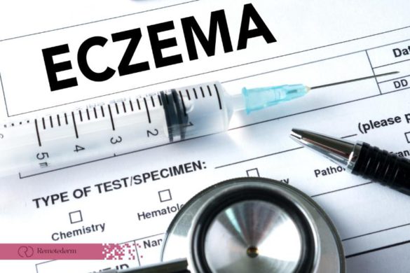Eczema vs. Skin Cancer - RemoteDerm