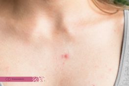 skin cancer types, Treatments and more about skin cancer rash