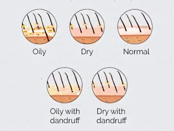 Different Types of Scalp Conditions - RemoteDerm