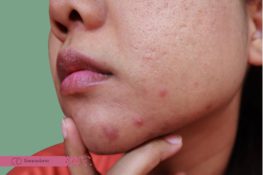 Understanding Weeping Eczema - RemoteDerm