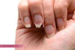 Nail Diseases Chart: Picture, Sign and Treatment