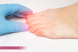 What is half moon on nails? - RemoteDerm