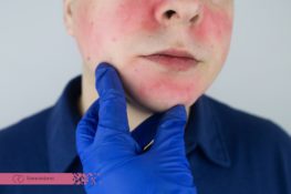 Exploring Facial Plethora - RemoteDerm