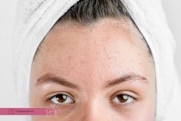 Facial Plethora: Causes and Treatments - RemoteDerm