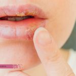 Facial Plethora: Causes and Treatments - RemoteDerm