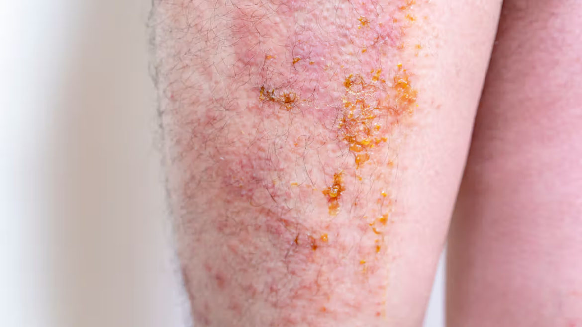 Understanding Weeping Eczema - RemoteDerm