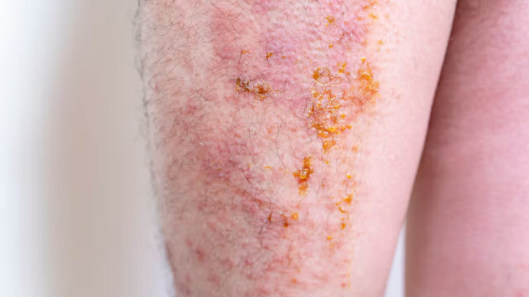 Understanding Weeping Eczema - RemoteDerm