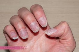 What Causes Terry's Nails? - RemoteDerm