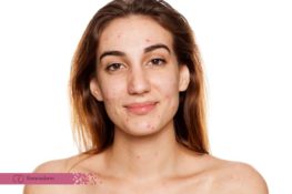 How to Get Rid of Keratin Plugs - RemoteDerm