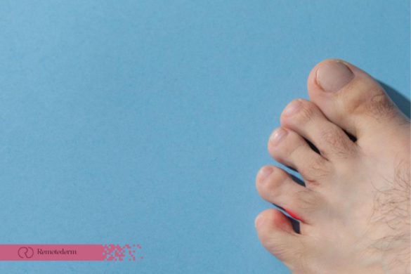 Nail Diseases Chart: Picture, Sign and Treatment