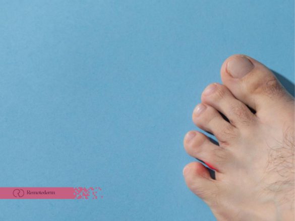 Blue Fingernails and Toenails - RemoteDerm