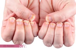 Nail Diseases Chart: Picture, Sign and Treatment