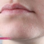 How To Get Rid of Sebum? - RemoteDerm