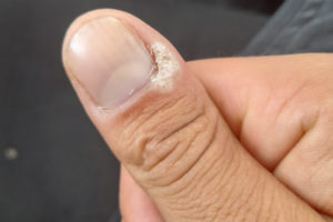 Periungual Warts Treatment - RemoteDerm