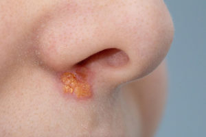 Understanding Cold Sore in the Nose - RemoteDerm