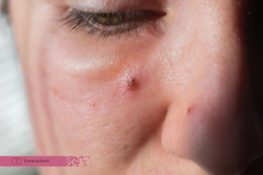 Exploring Facial Plethora - RemoteDerm