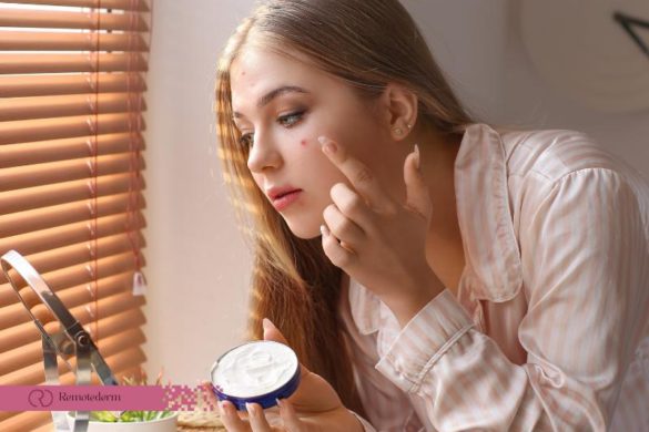 Perioral Dermatitis: Causes, Symptoms and Treatment - RemoteDerm