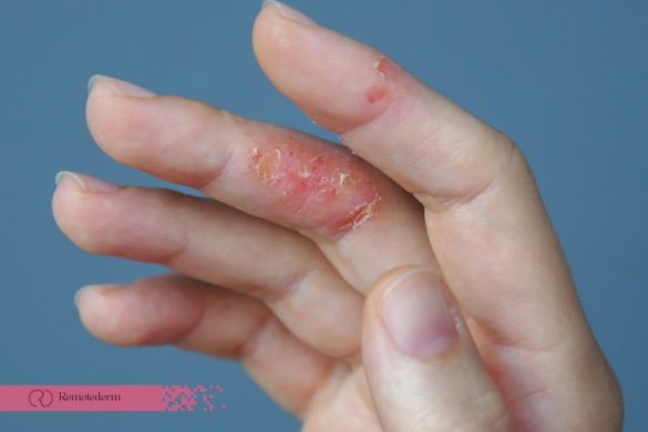 Eczema vs. Skin Cancer - RemoteDerm