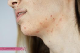 How to Get Rid of Keratin Plugs - RemoteDerm