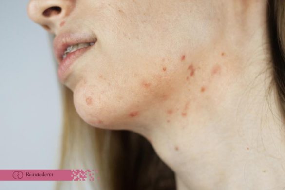 Exploring Facial Plethora - RemoteDerm