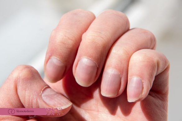Nail Diseases Chart: Picture, Sign and Treatment