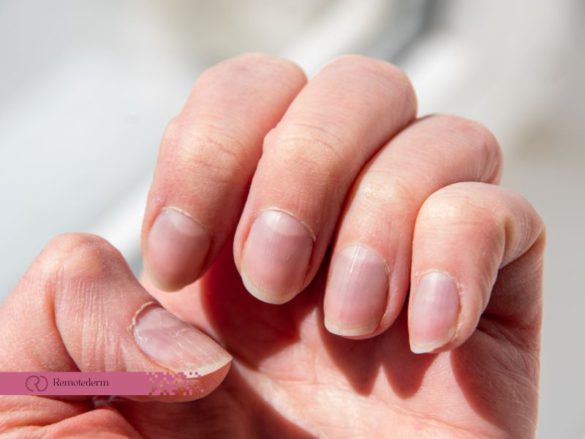 What Are Spoon Nails? - RemoteDerm