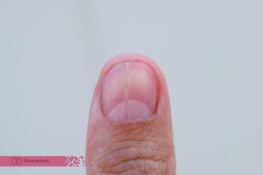Caring for the Proximal Nail Fold - RemoteDerm