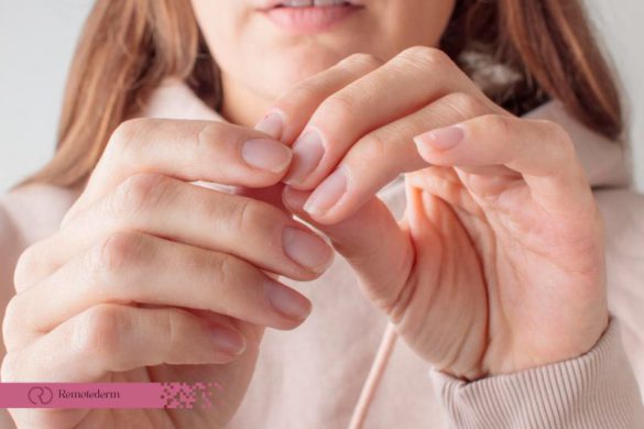 Understanding the Nail Matrix - RemoteDerm