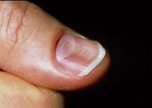 What Are Spoon Nails? - RemoteDerm