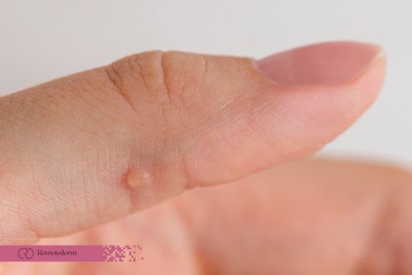 Phymatous Rosacea Treatments, Causes, Symptoms - RemoteDerm