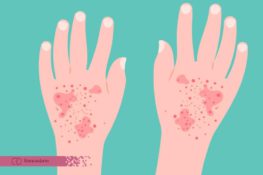 What causes filiform warts - RemoteDerm