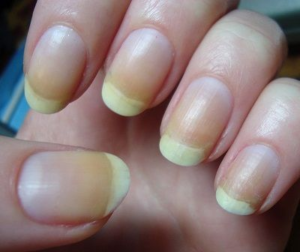 Yellow Nails Causes & Treatment - RemoteDerm