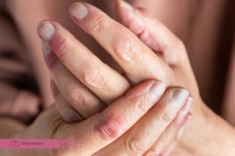 Understanding Skin Discoloration - RemoteDerm