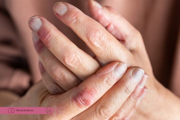 Understanding Skin Discoloration - RemoteDerm