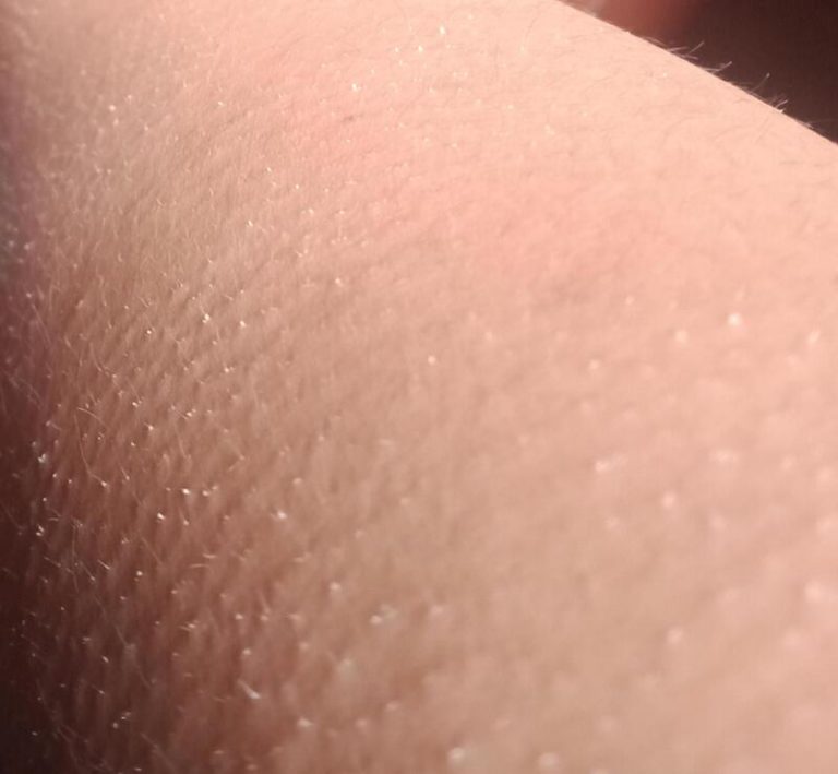 How to Get Rid of Keratin Plugs - RemoteDerm