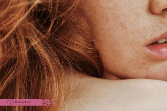 Shaving for Acne-Prone Skin: Dermatologist Tips - Remotederm