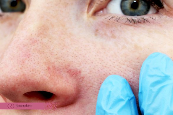 Ringworm Rashes Causes And Treatments Remotederm