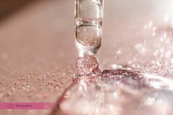 Understanding Epidermal Inclusion Cysts - RemoteDerm